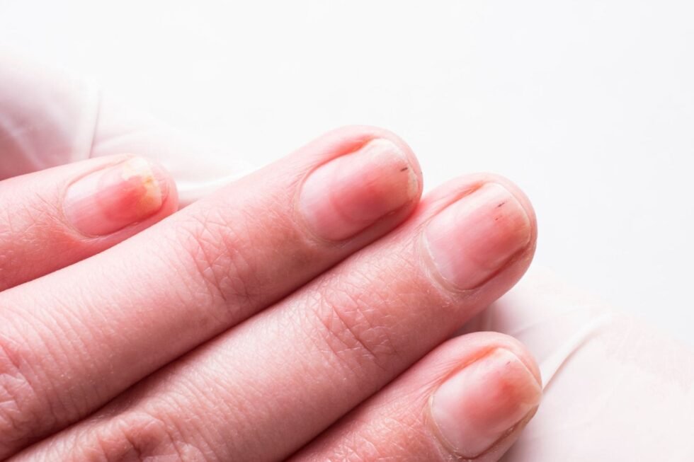 Ongle qui se décolle : 6 remèdes naturels qui marchent
